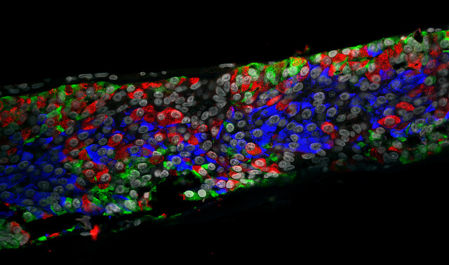 Ten years in, first trial treatment from California’s stem cell ...