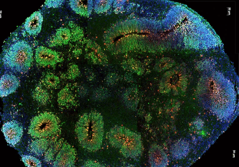 ‘A village in a dish’: Mini brain organoids made of cells from multiple ...