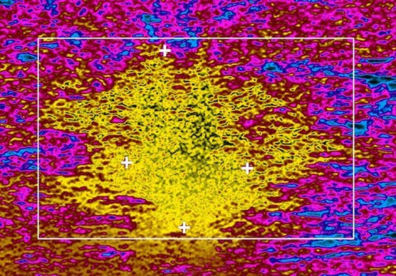 Balancing cancer detection and finding false positives: Enhancing tumor ...