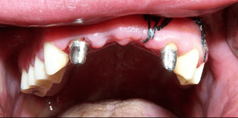 Missing teeth? A drug that that spurs regrowth shows promise - Genetic ...