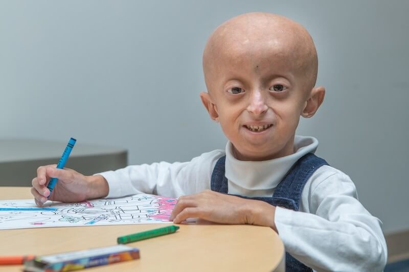 400 children worldwide are born each year with ‘fast-aging disease ...