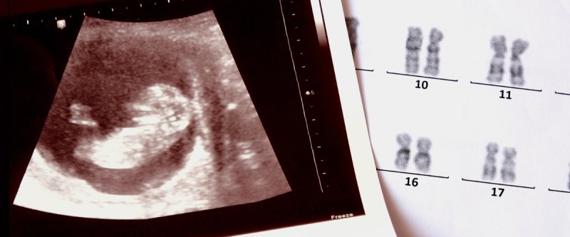 Treating genetic disorders before birth: Prenatal and newborn genetic ...
