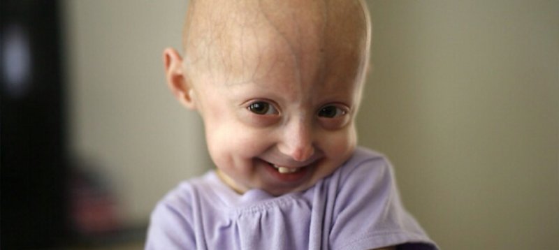 There are 400 children worldwide with progeria, a rapid-aging disease ...